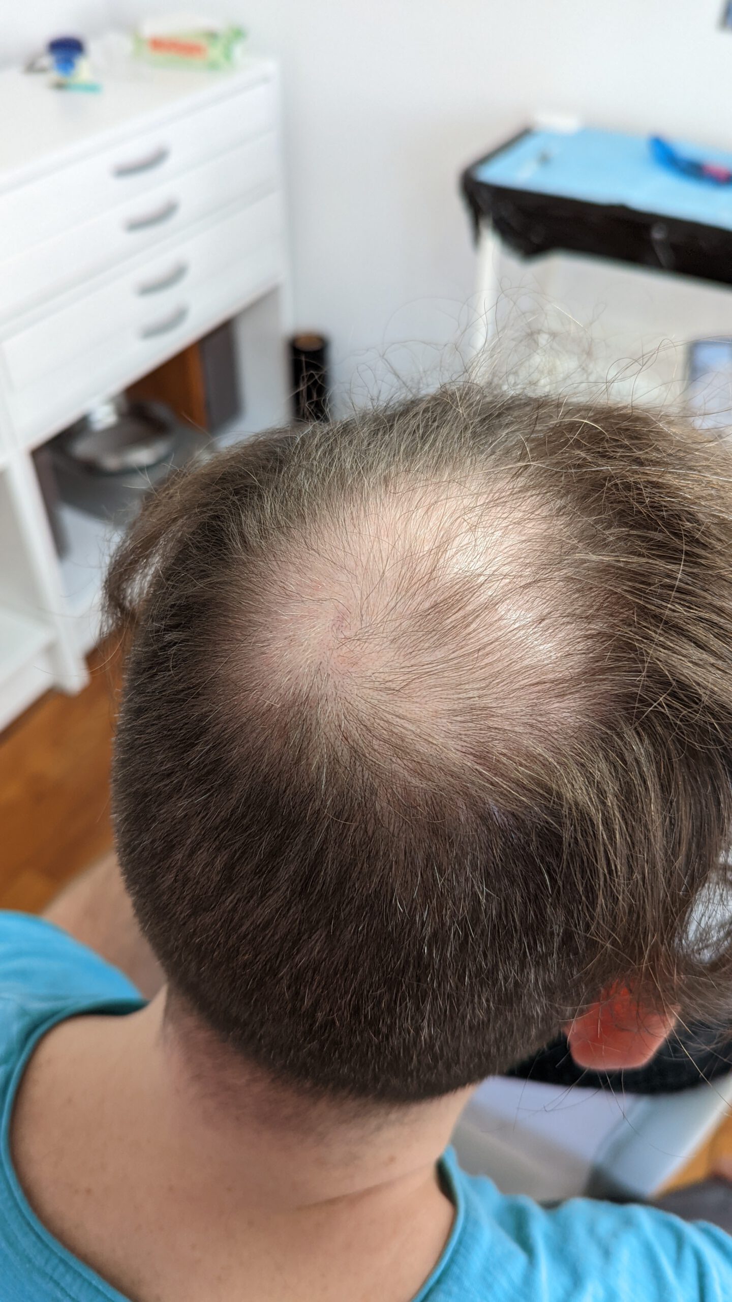 Scalp Microblading - Real Pigmentation